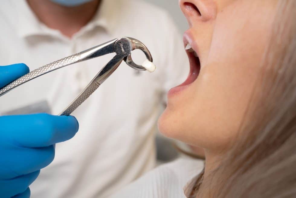 Wisdom Teeth Extraction: When and Why | Aardent Dental Centre
